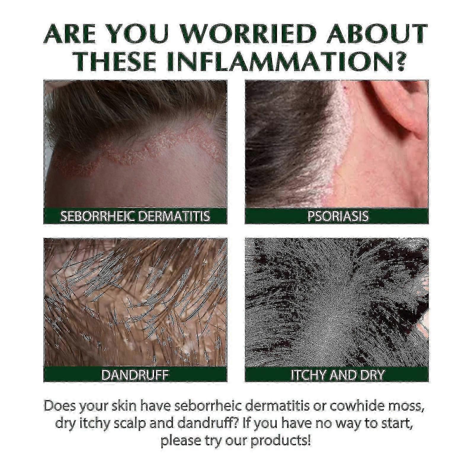 head Moss anti-itching shampoo hair oil control scalp cleaning anti ...