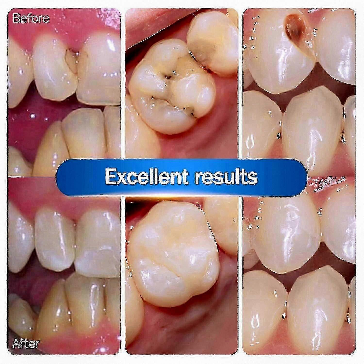 Strong Dental Cement for Teeth Repair, Cavity Filling & Restoration ...