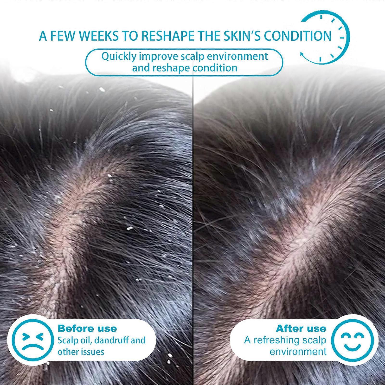 Dermatite séborrhéique Psoriasis Shampooing-cuir chevelu Pour la ...