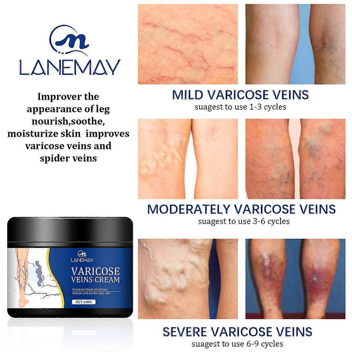 Varicose Vein Cream 50g Varicose Vein Cream Anti-spider And Vein Removal Varicose Leg Care ...