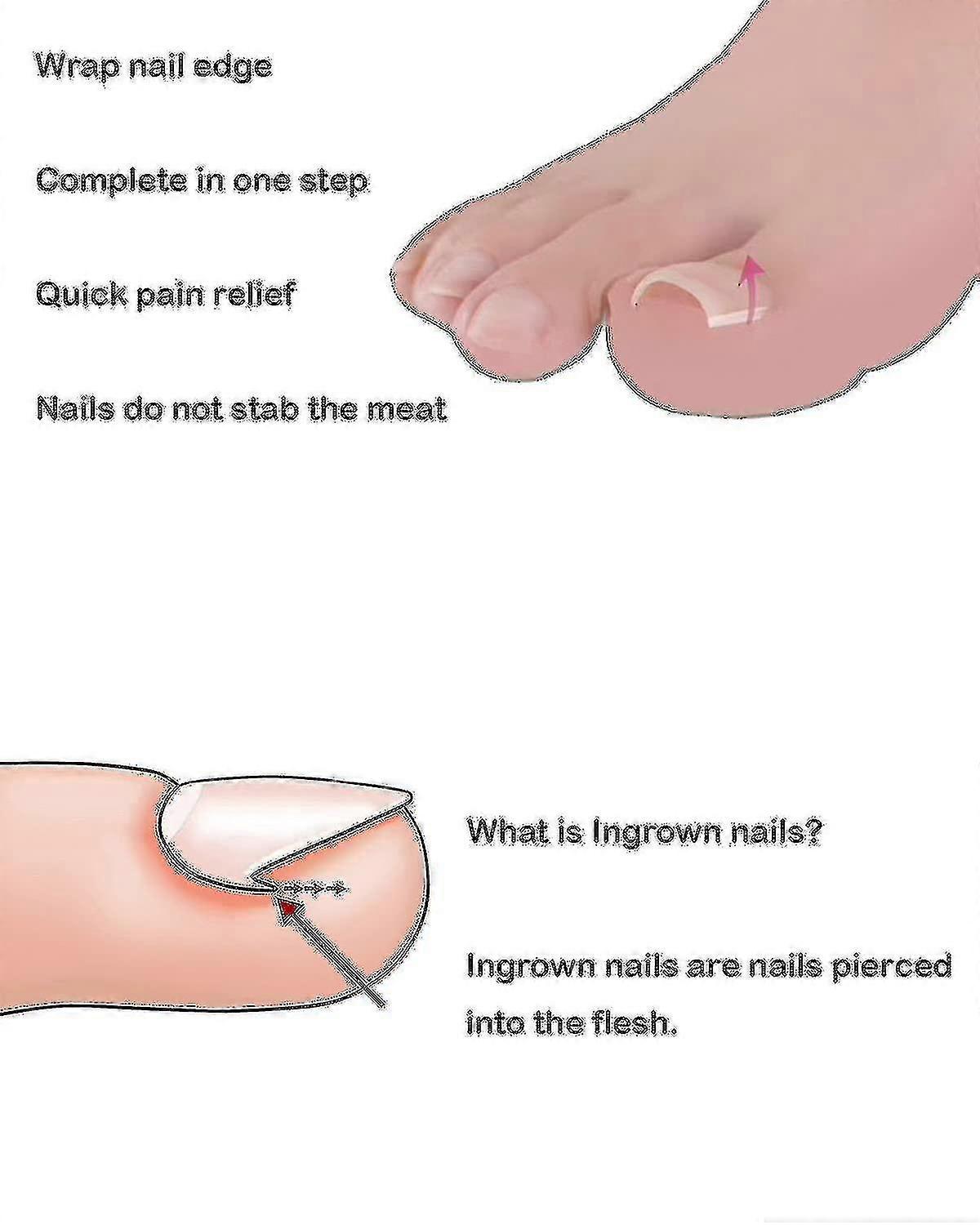 (50+2) Pack Professional Ingrown Toenail Correction Treatment Kit, 50 ...