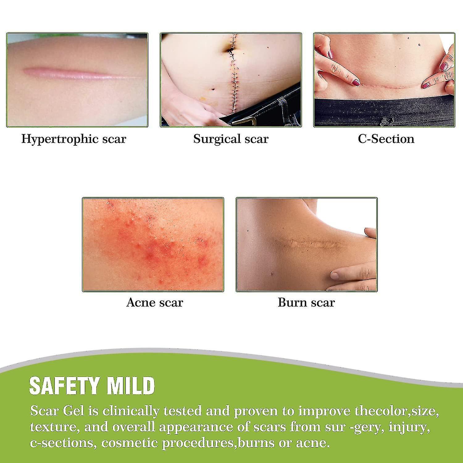 Silicone Plasters For Scars, Silicone Scar Plasters, Silicone Scar ...