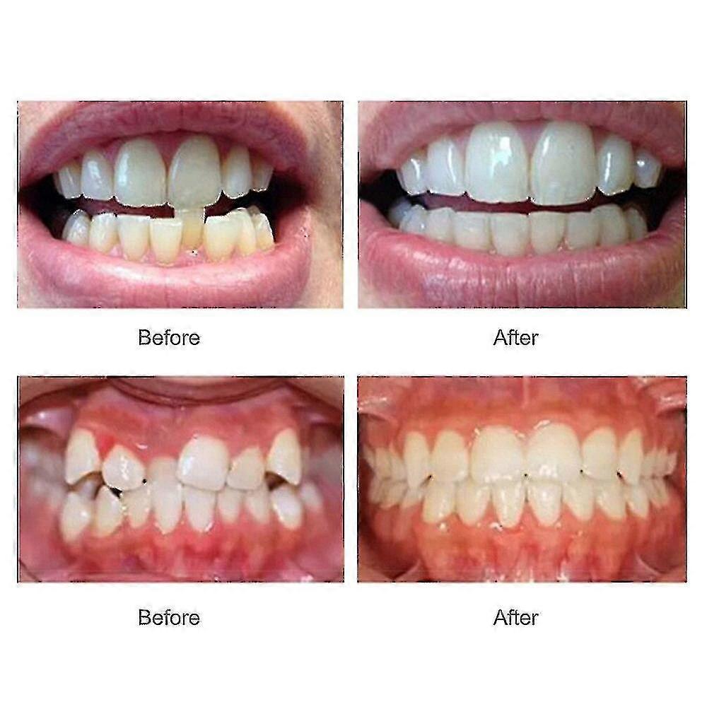 Teeth straightener, dental braces orthodontic teeth trainer set for ...