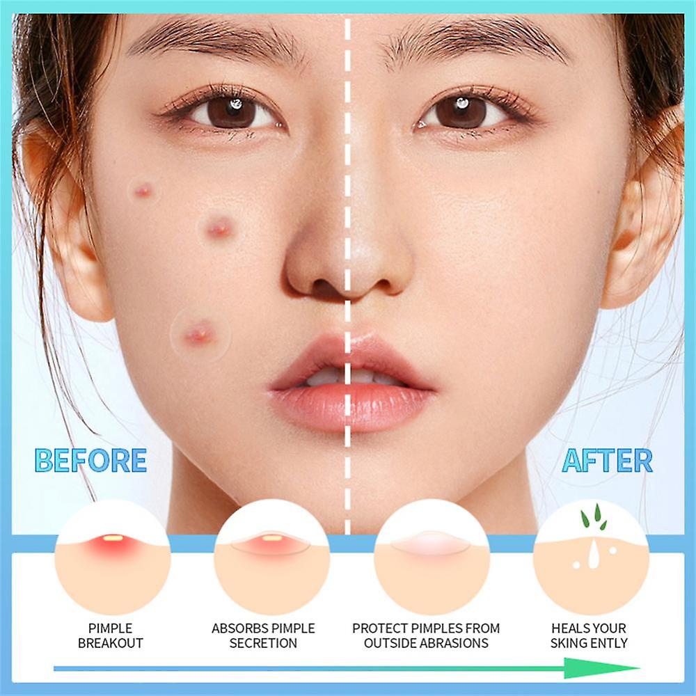 72 Pcs Invisible Skin Tag Warts Removal Stickers Hydrocolloid Acne ...