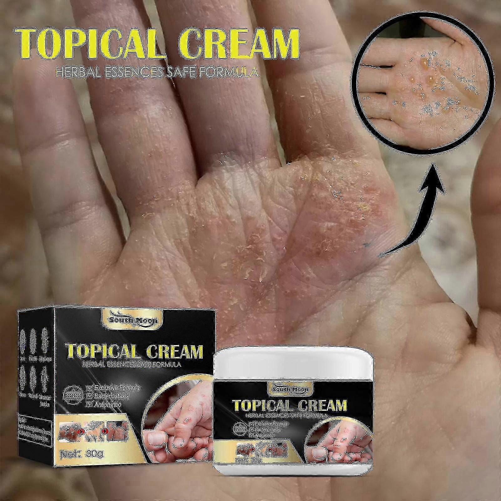 Anti-itch Cream For Sweaty Hands And Feet Dry Itchy Skin Itchy Mosquito ...