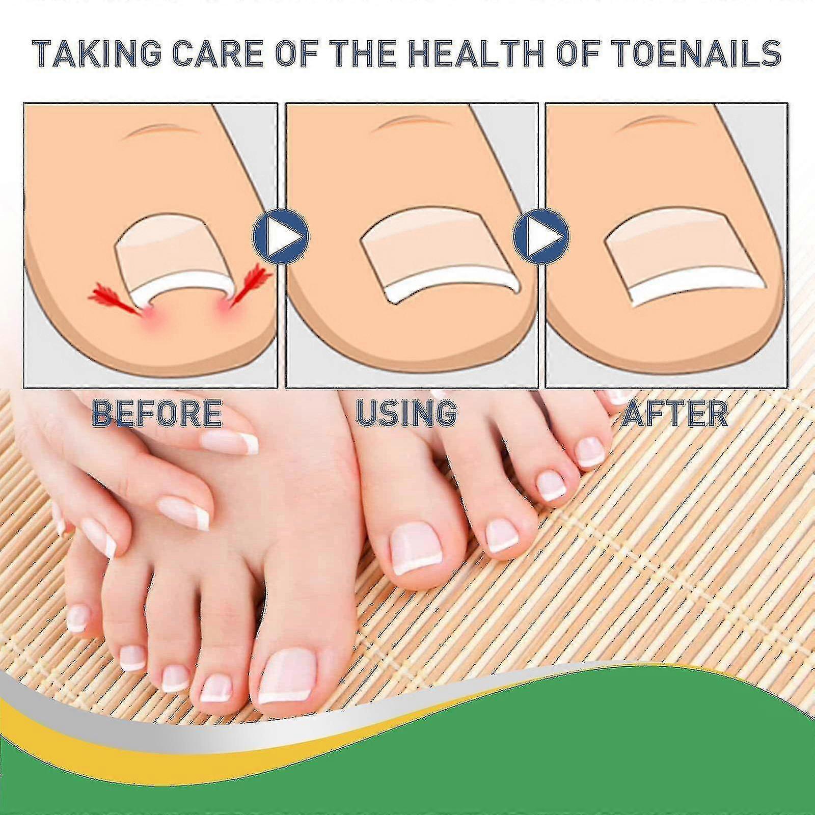 50 Sticks Toenail Groove Correction Stickers Nail Repair Toe Ingrown ...