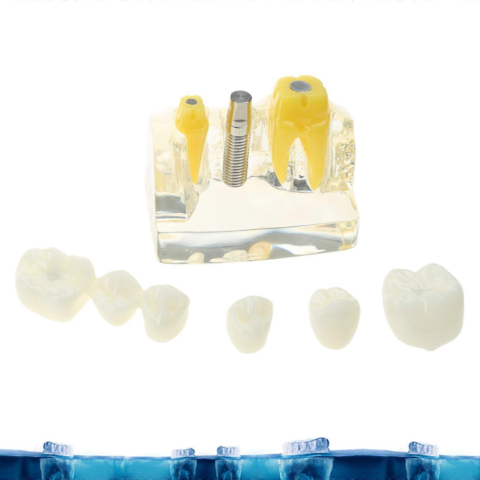 Dental Implant Analysis Crown Bridge Model 4 Times Dental Implant Teeth ...