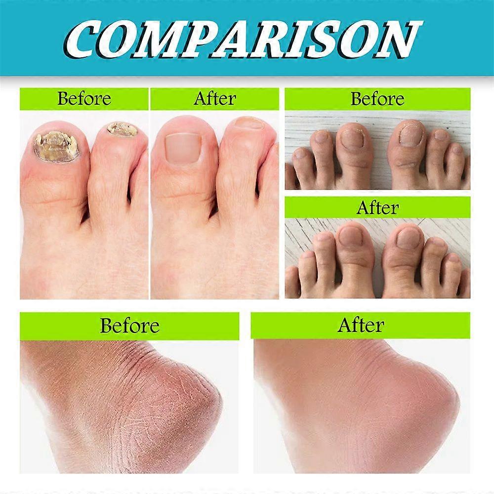 Foot And Nail Spary, Natural And Powerful Foot Care | Fruugo UK