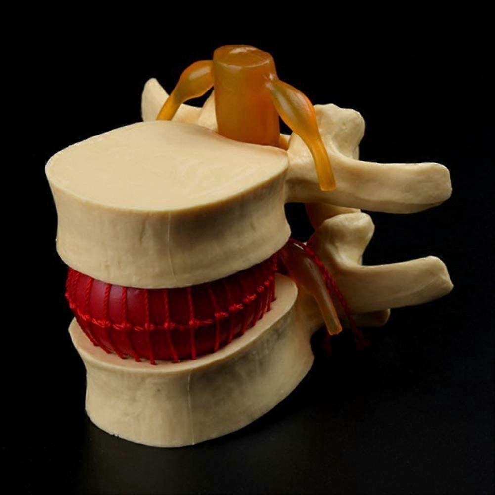Lumbar Vertebrae Model Anatomical Spine Lumbar Disc Herniation Anatomy ...