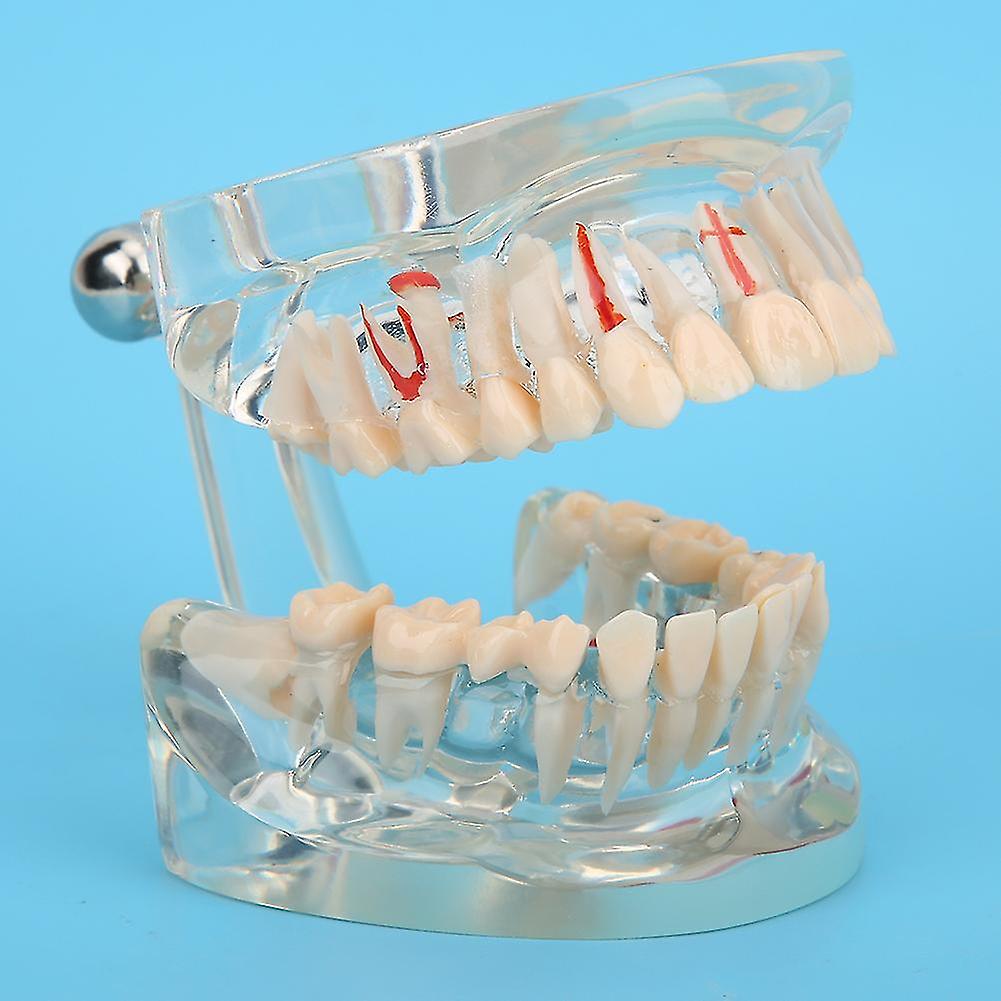 Adult Teeth Pathological Model Dental Implant Model Dental Study ...