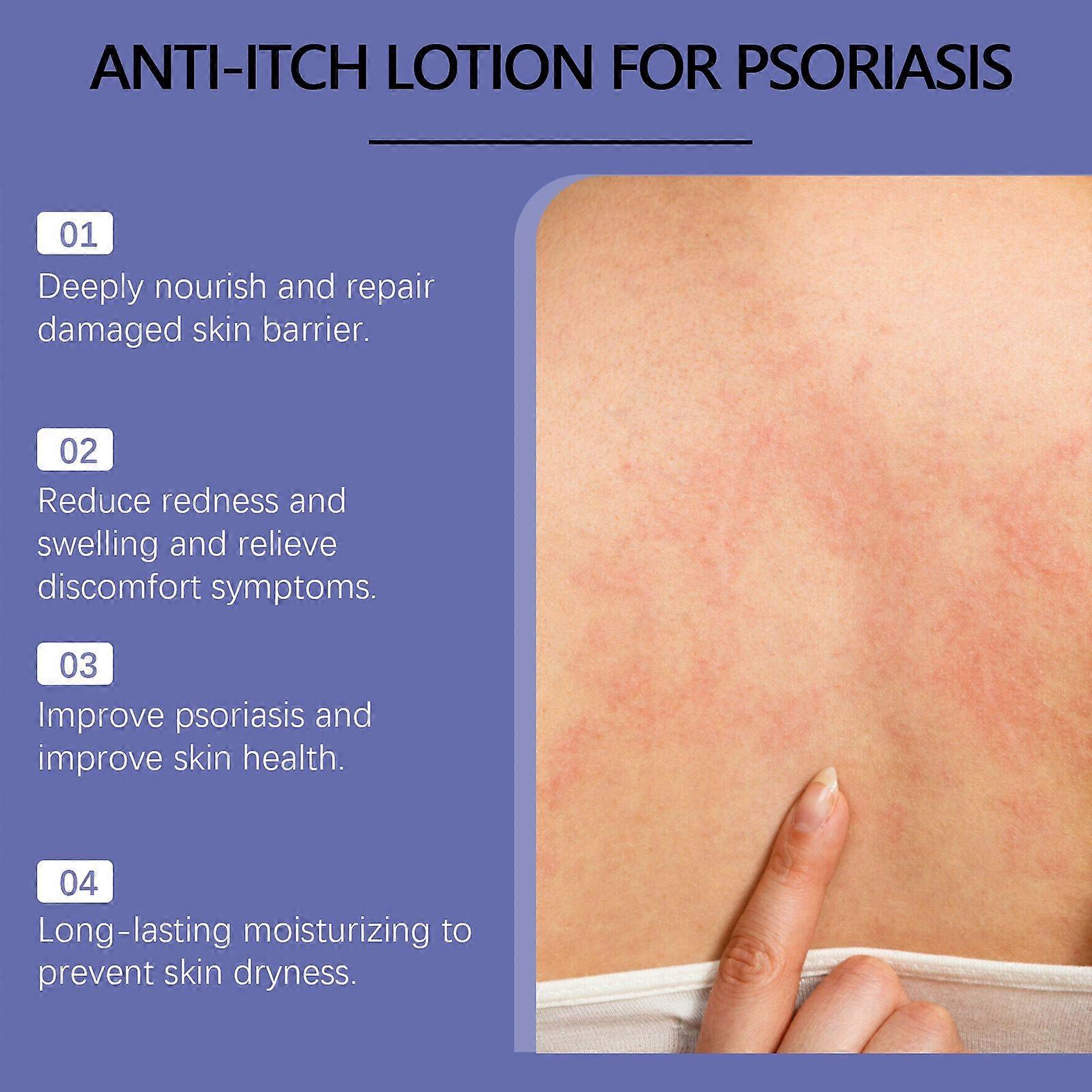 Psoriasis Relief Cream - Anti-itch Lotion for Psoriasis - Itch Relief ...
