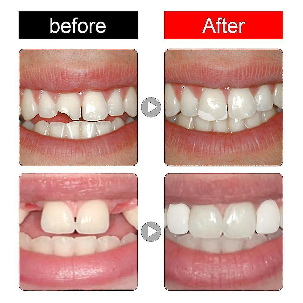 Moldable Tooth Filling False Teeth Temporary Repair Kit Solid Glue ...