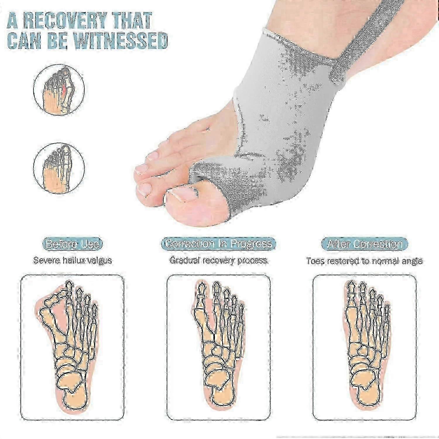 Hyggear Adjustable Bunion Corrector with Silicone Pads - Toe Separator ...