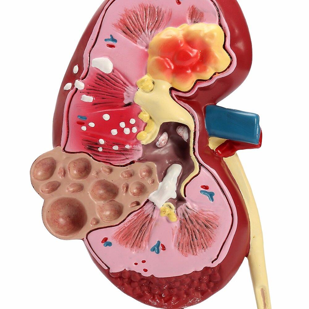 Kidney Pathology Model Human Anatomy Pathological Kidney Model For ...