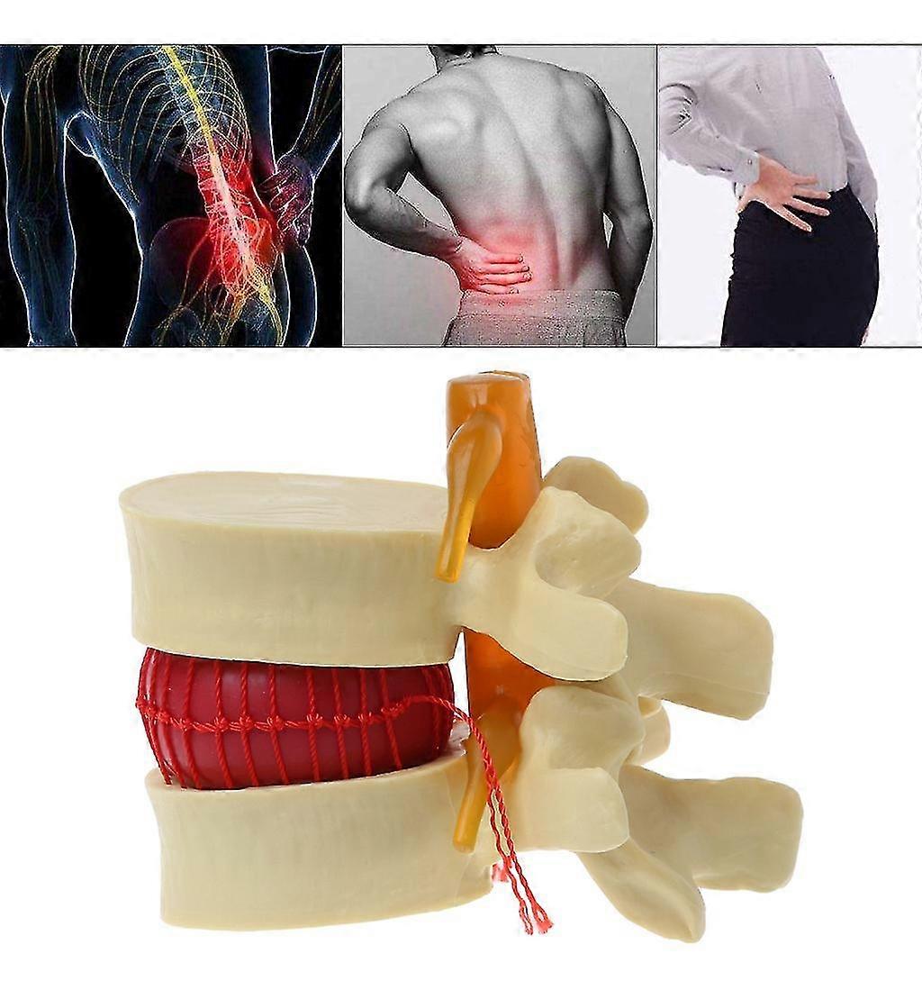 Lumbar Spinal Disc Herniated Spine Anatomical Anatoyellow1pcs | Fruugo UK