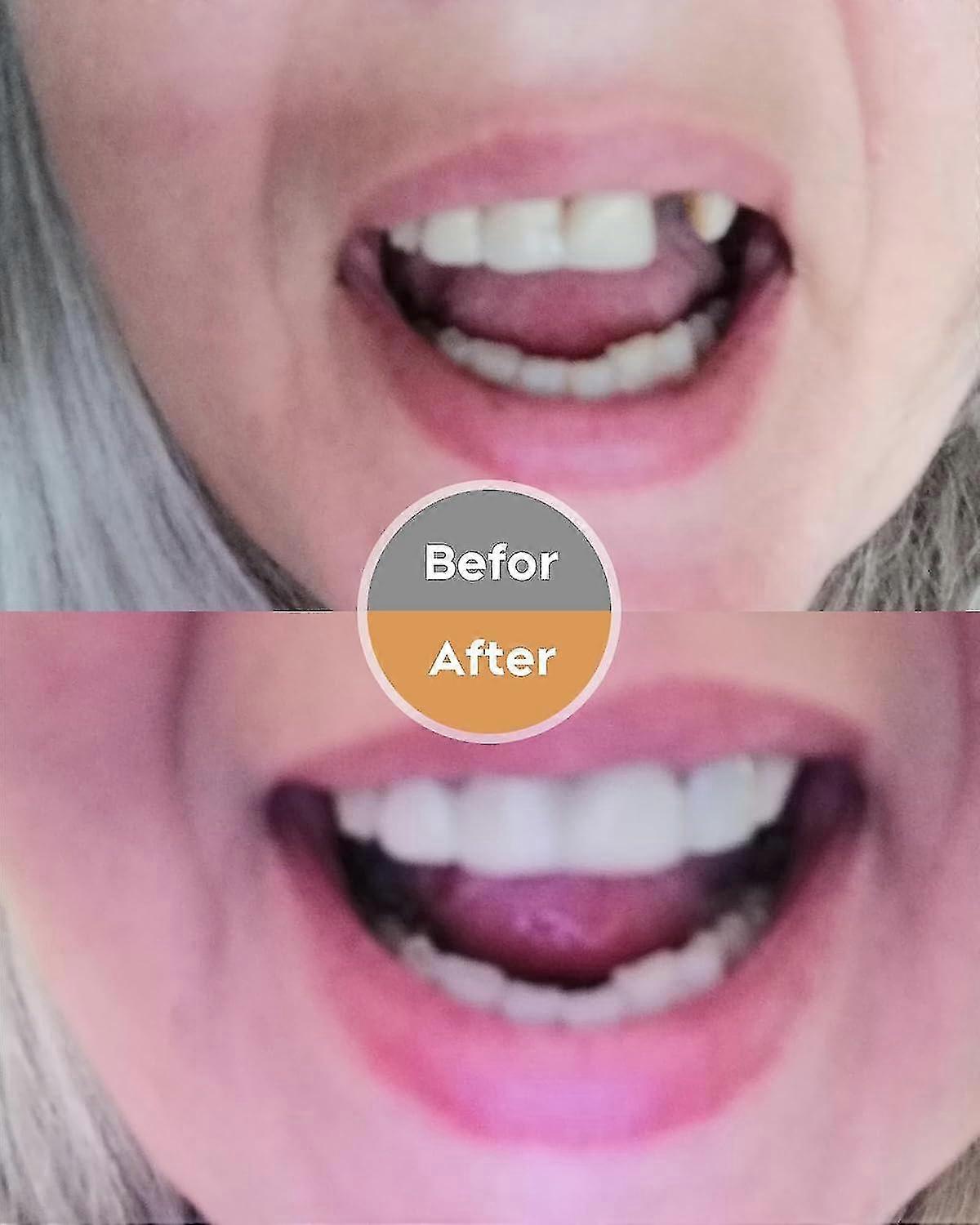 Dentures Diy Kit Create Your Perfect Smile At Home: Diy Denture Fake ...