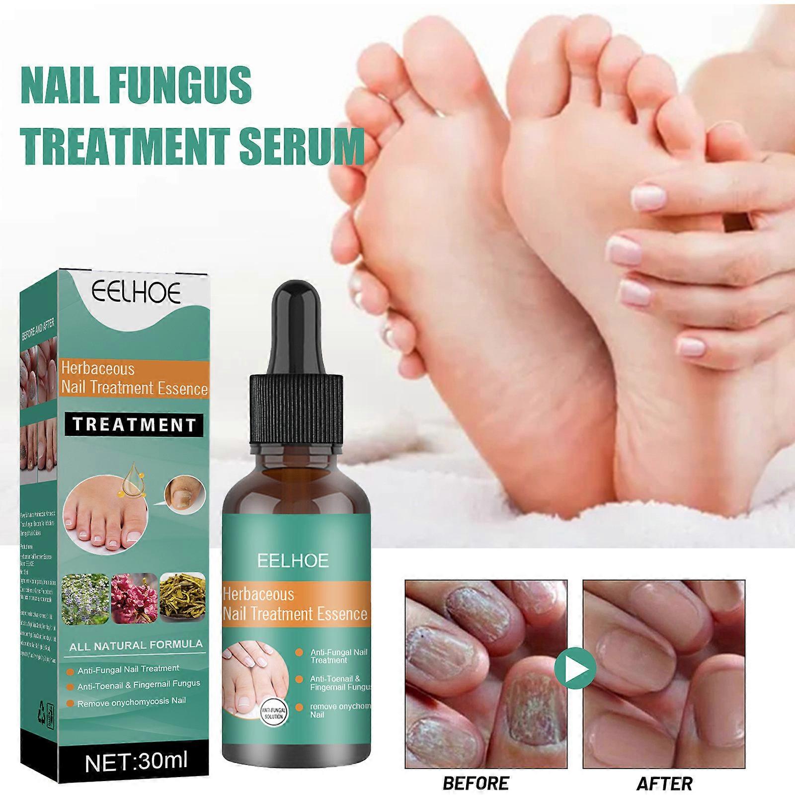 Extra Strength Nail Repair Fluid Toenail And Nail Solution Toenails And ...