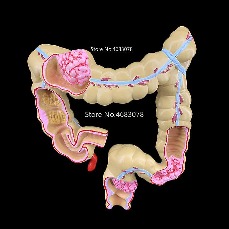 Colorectal Lesion Model Human Colon Large Intestine Pathological ...
