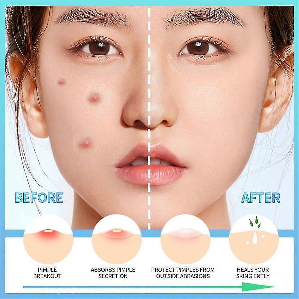 72 Pcs Invisible Skin Tag Warts Removal Stickers Hydrocolloid Acne ...