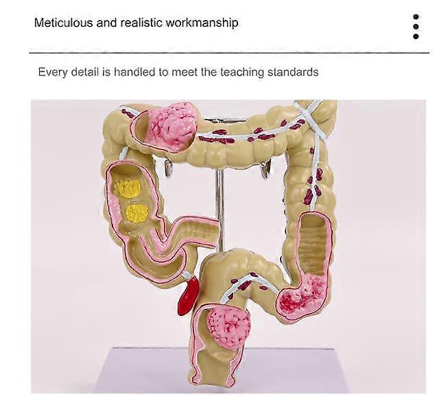 Large Intestine Pathology Model Stomach / Intestine, Human Colon ...