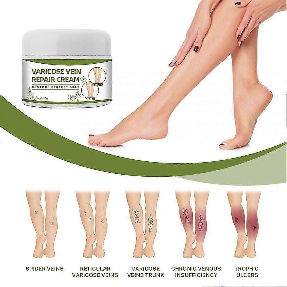 Varicose Vein Cream 50g Varicose Vein Cream Anti-spider And Vein ...