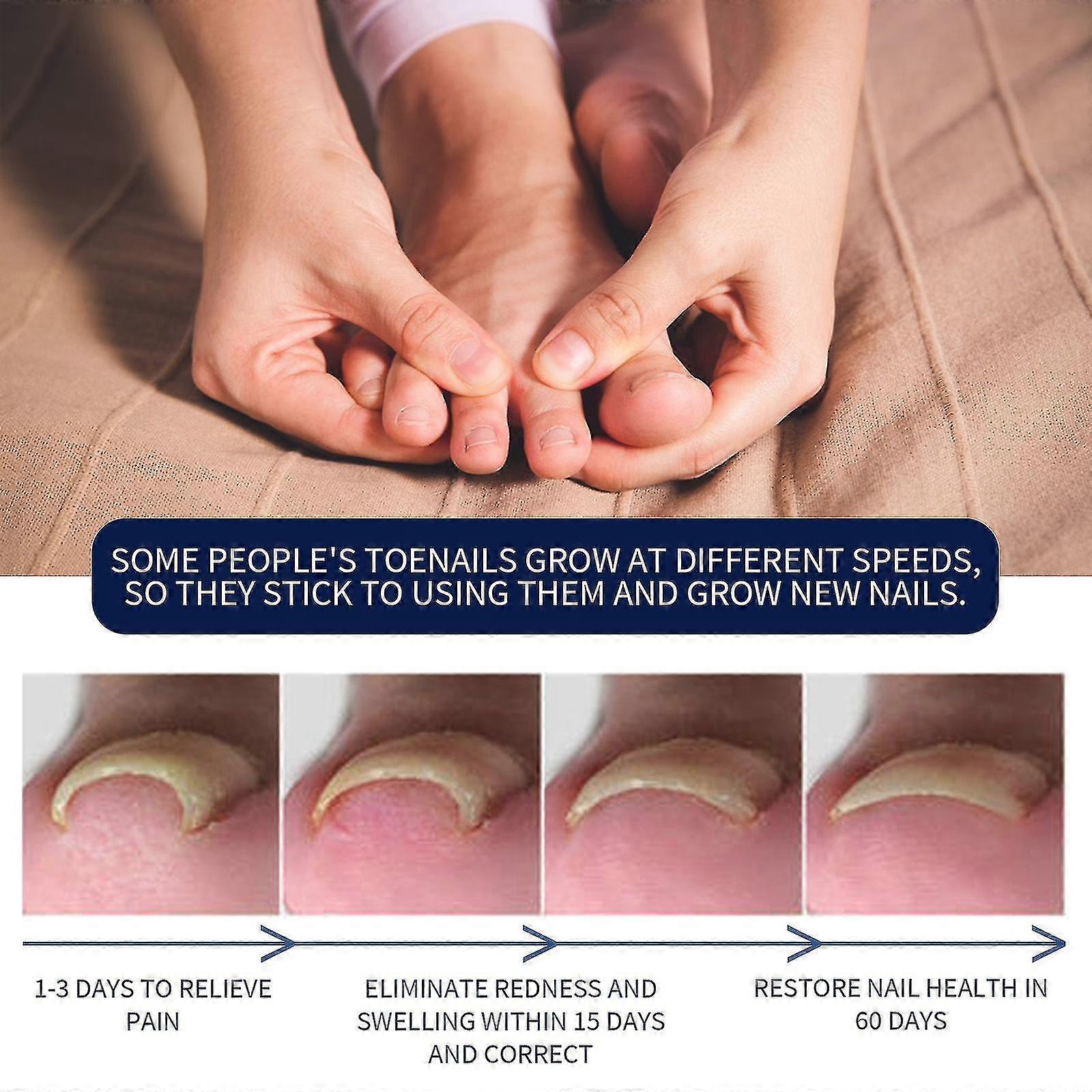 Toe Nail Care Removal Paronychia Oil, Toe Nail Anti Paronychia Relief ...