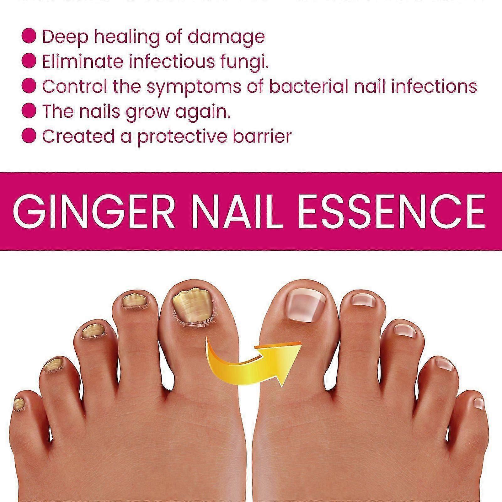 Ginger Nail Treatment - Nail Fungus Removal, Nail Fungus Treatment for ...