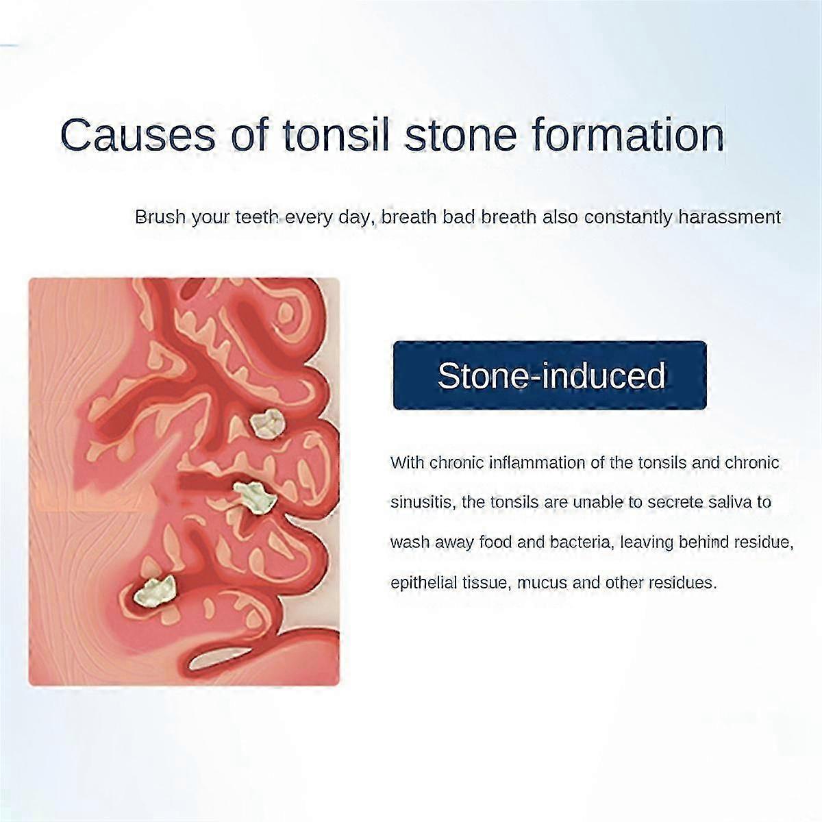 Electronic Tonsil Stone Remover Vacuum, Tonsil Stone Removal Kit ...