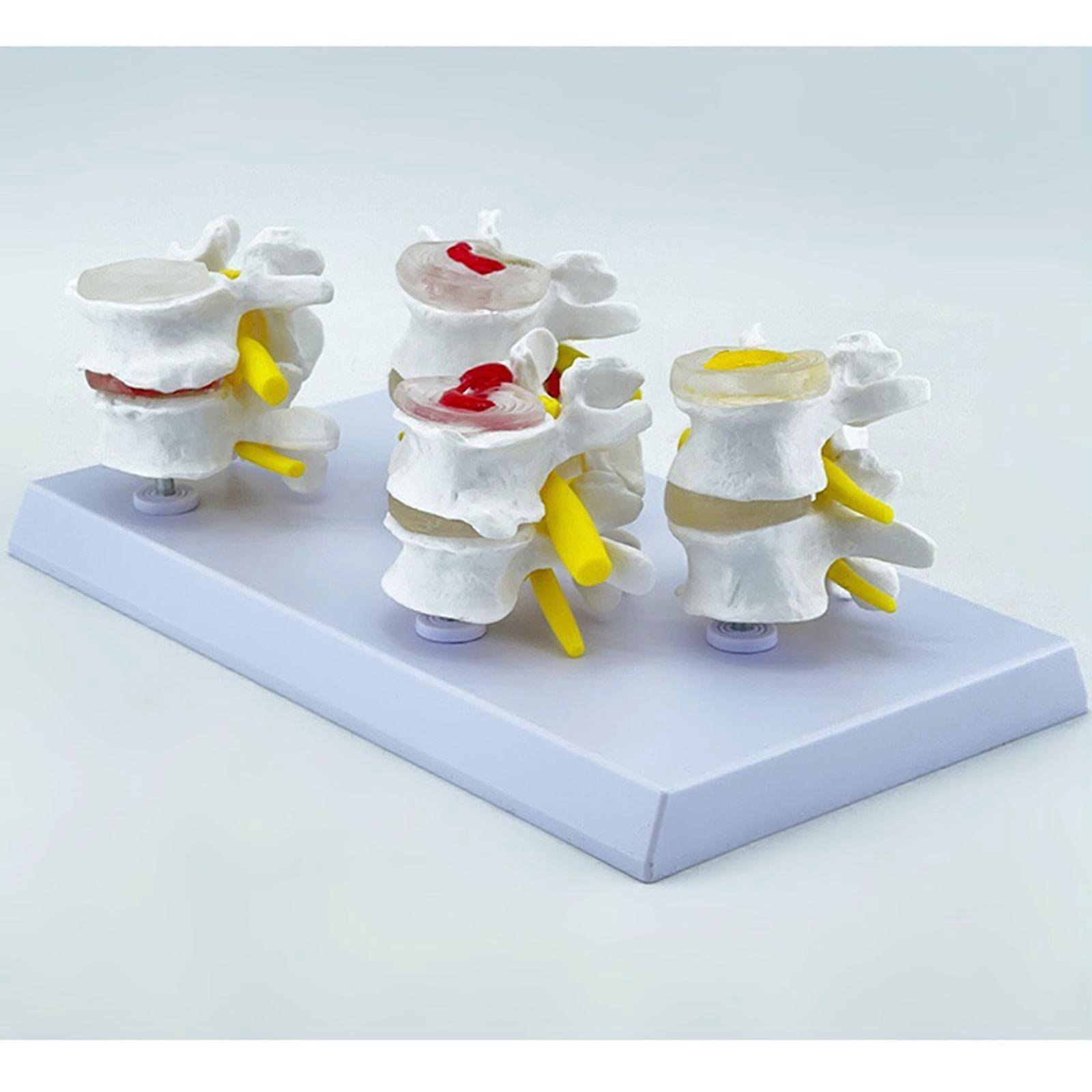 Human Skeleton Model for Anatomy Lumbar Spine 4 Stages Lesions ...