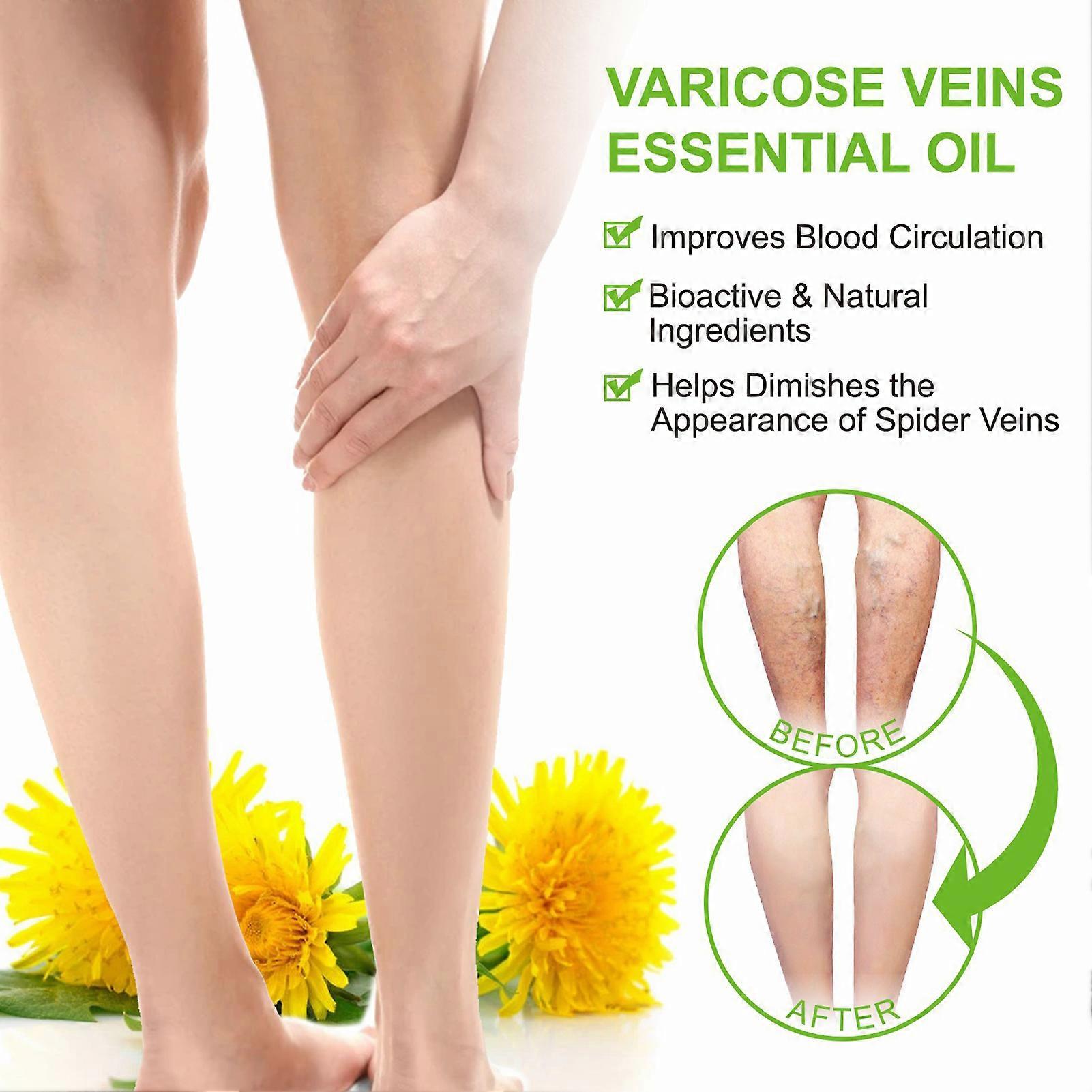 Varicose Veins Treatment Serum Varicosity Angiitis Remedy Ointment ...