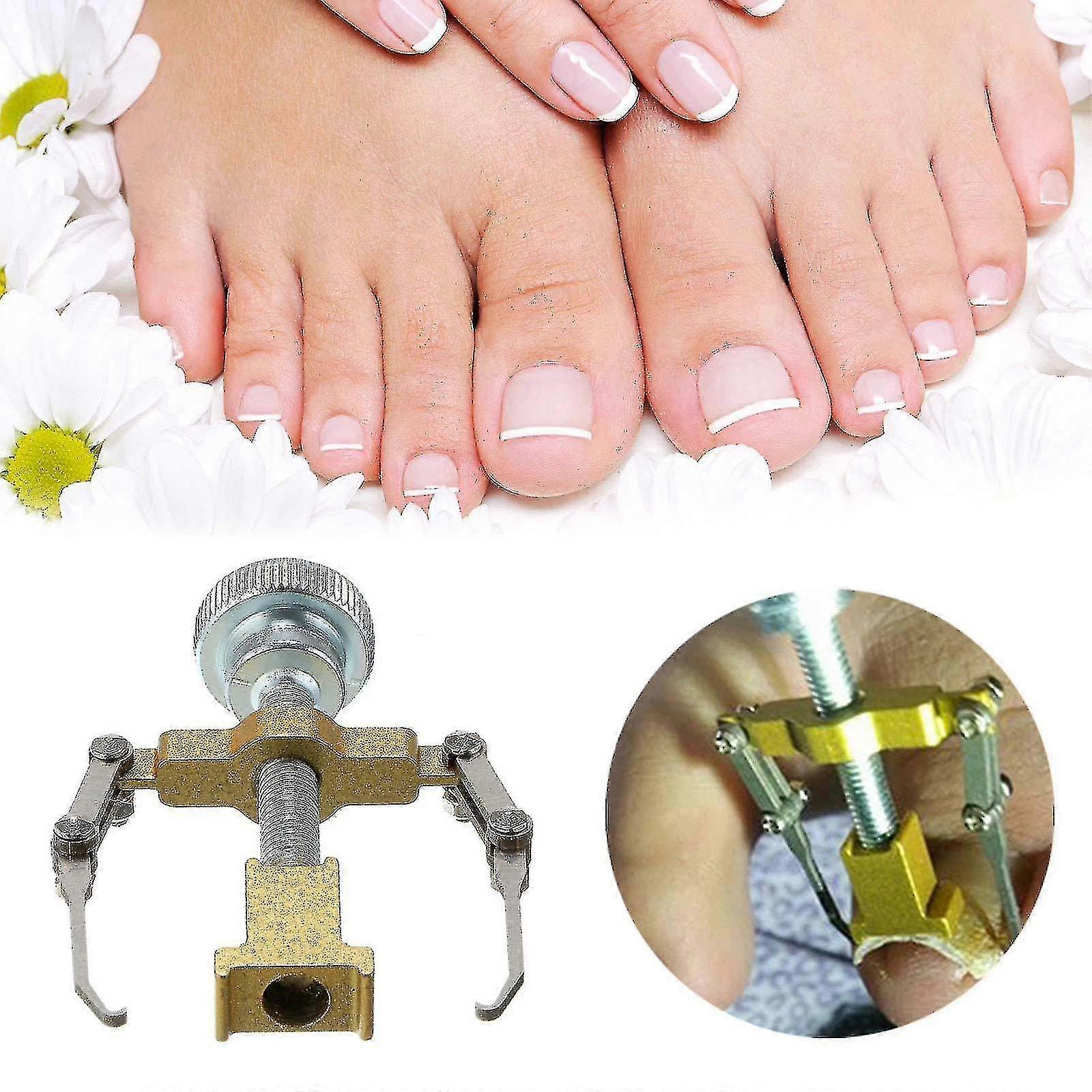 Ingrown Toenail Manicure Pedicure Foot Care Correction Brace Tool Toe ...