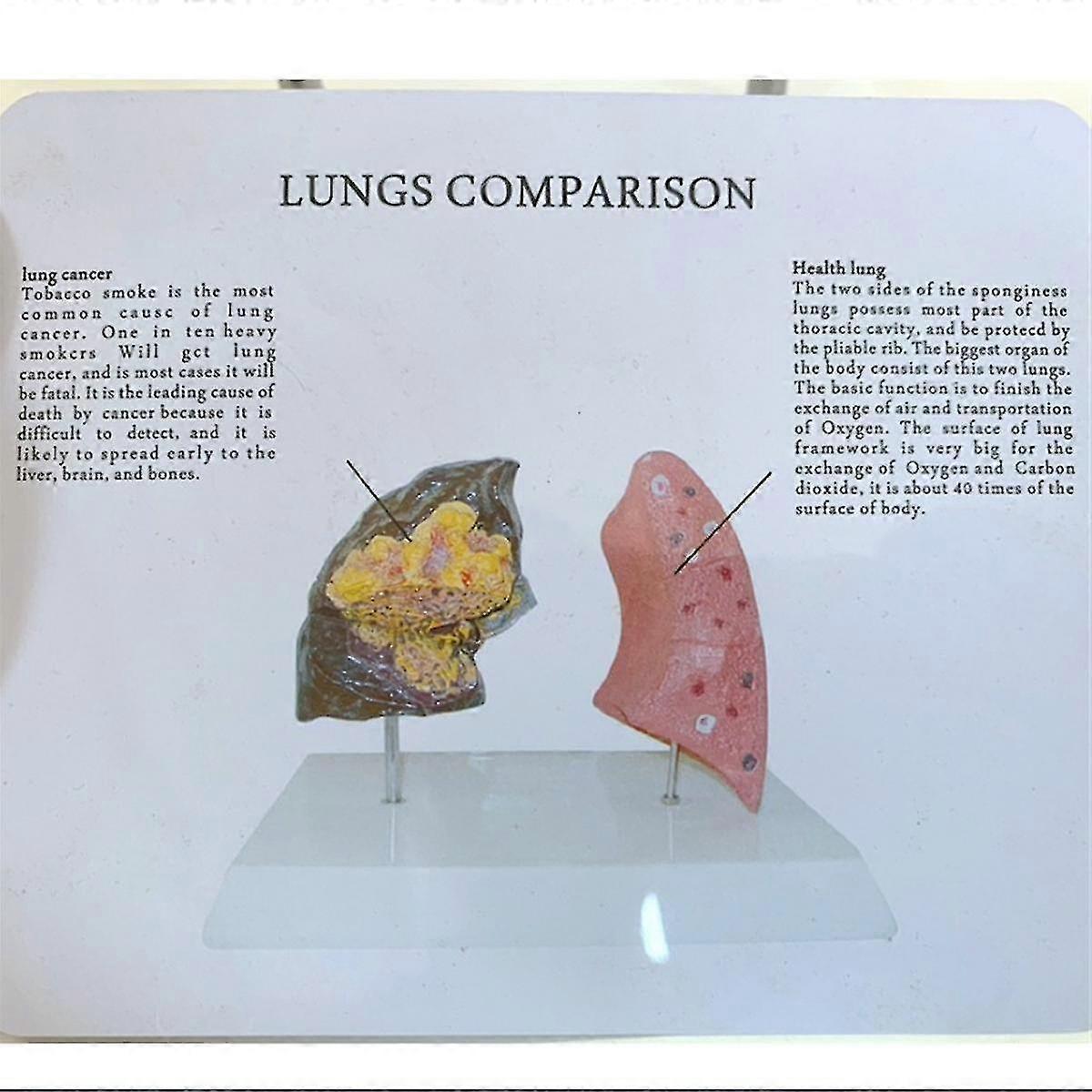 Smoker'S Lung Model Healthy Lung Model Lung Anatomy Model with ...