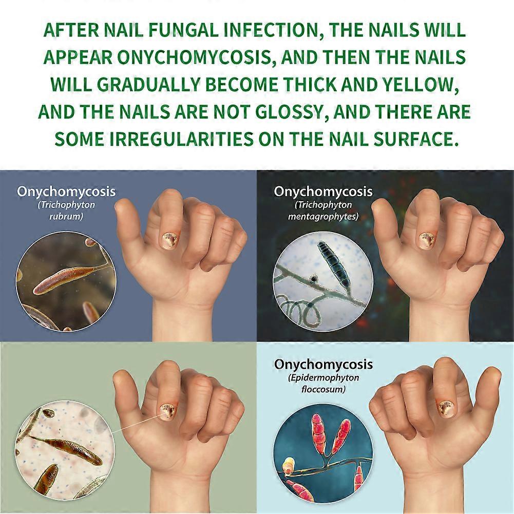 3X 30ml Nails Care Repair Nail Fungal Anti-Fungus Onychomycosis-Removal ...