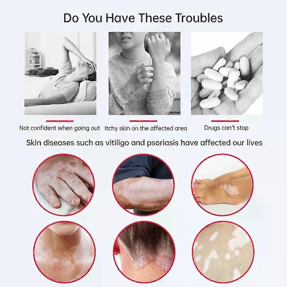 UV 311nm Ultraviolet Phototherapy Device Uses Philips Lamp UVB To Treat ...