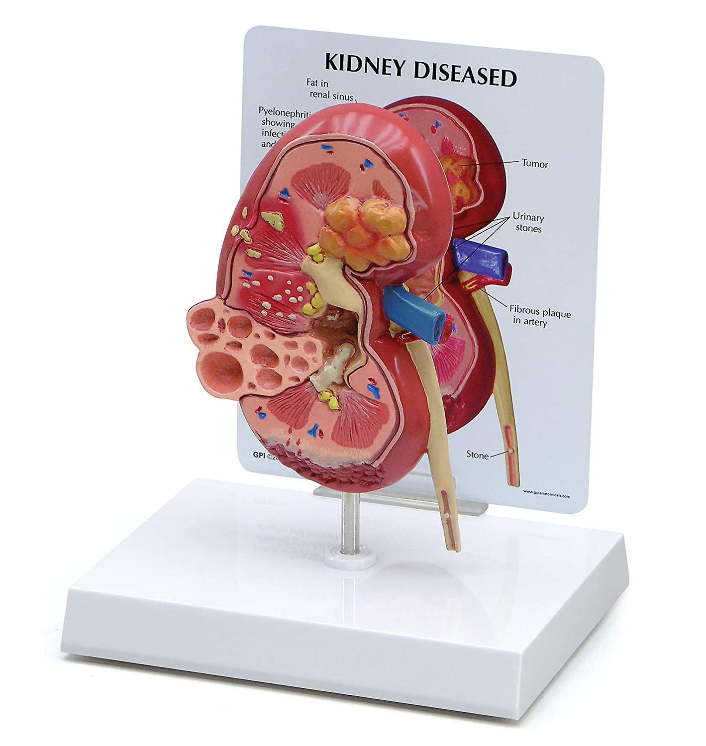 Kidney Pathologies Model Human Body Anatomy Replica Of Diseased Kidney ...