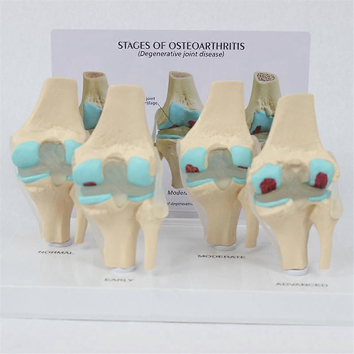 Knee Kit Osteoarthritis Anatomy Model with Educational Key Card 4 Stage ...