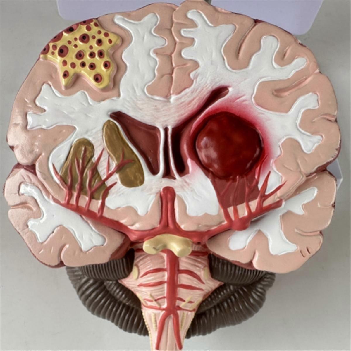 Human Brain Disease Model - Brain Pathology Brainstem Hemorrhage ...