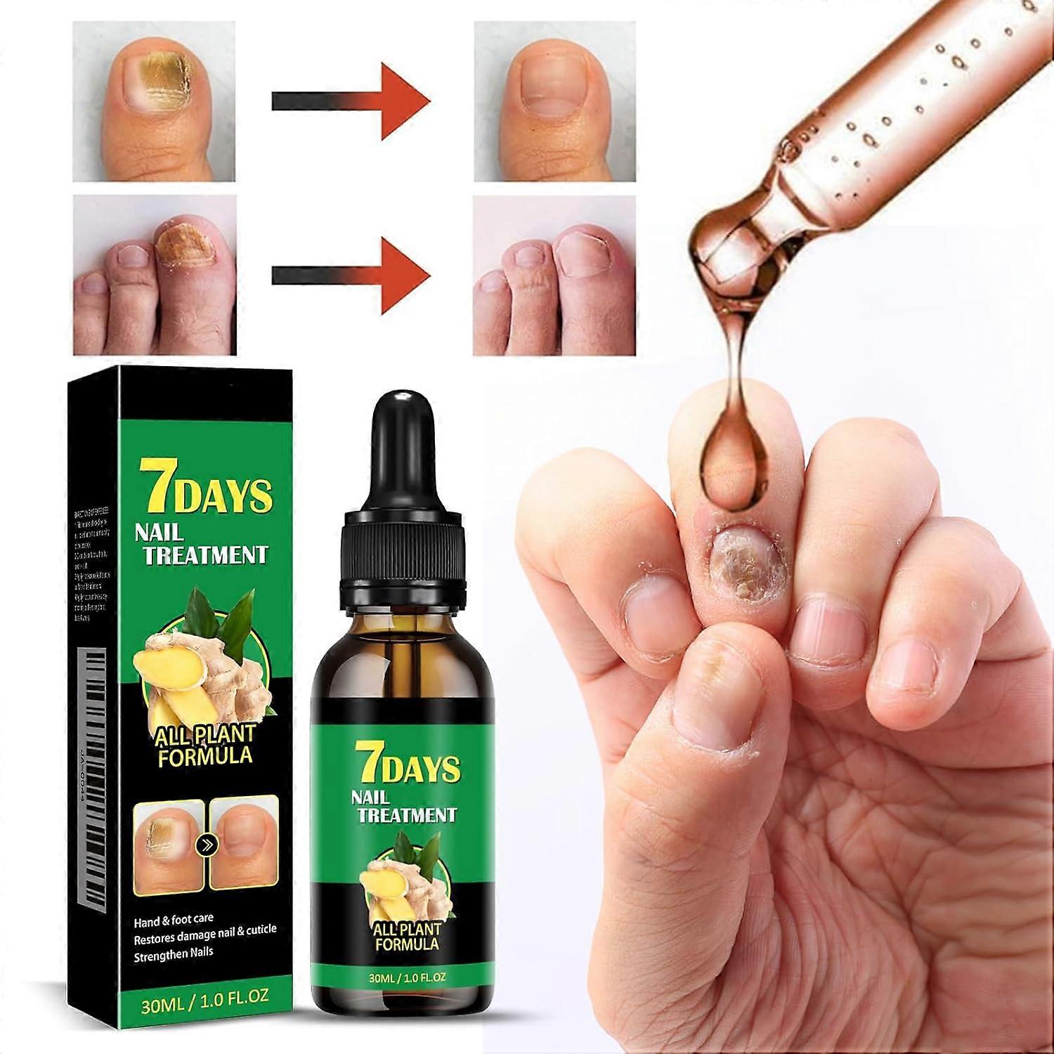 7days Nail Treatment, Ginger Nail Treatment, Multi-Purpose Nail Repair ...