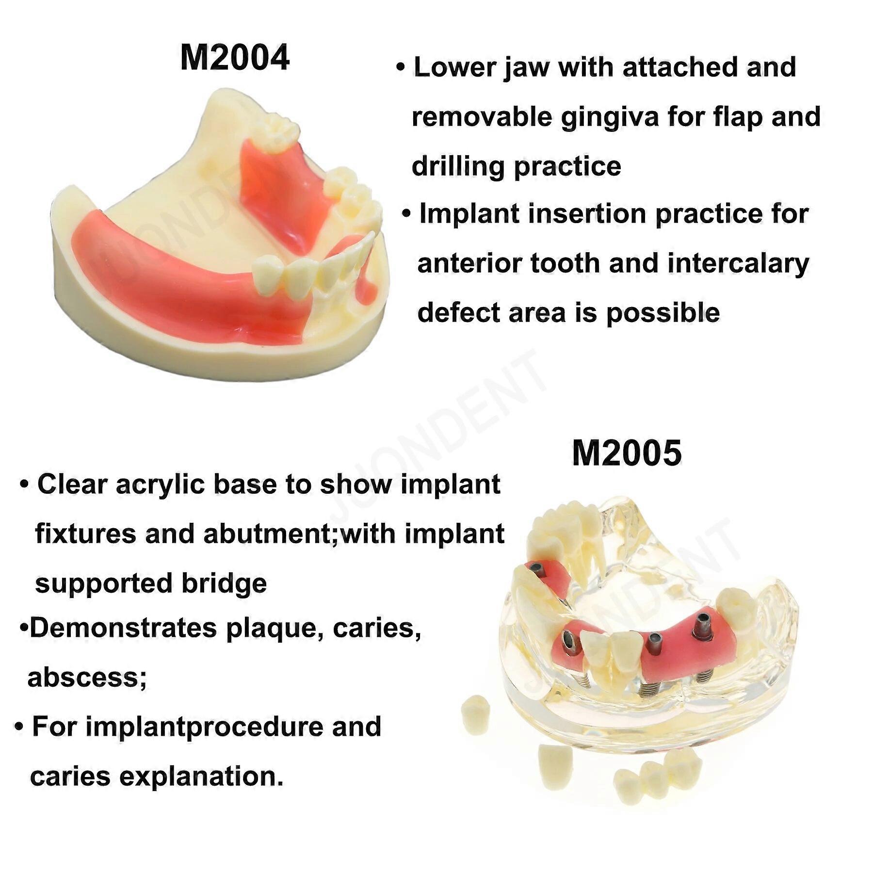 Dental Model Dental Teaching Model Overdenture Implant Models For ...