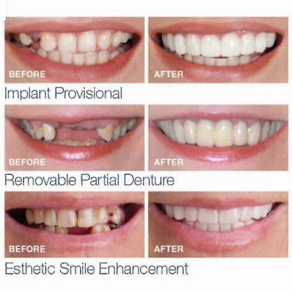 Dental Veneers Dentures Tooth Cover Set - Snap On False Teeth Upper ...