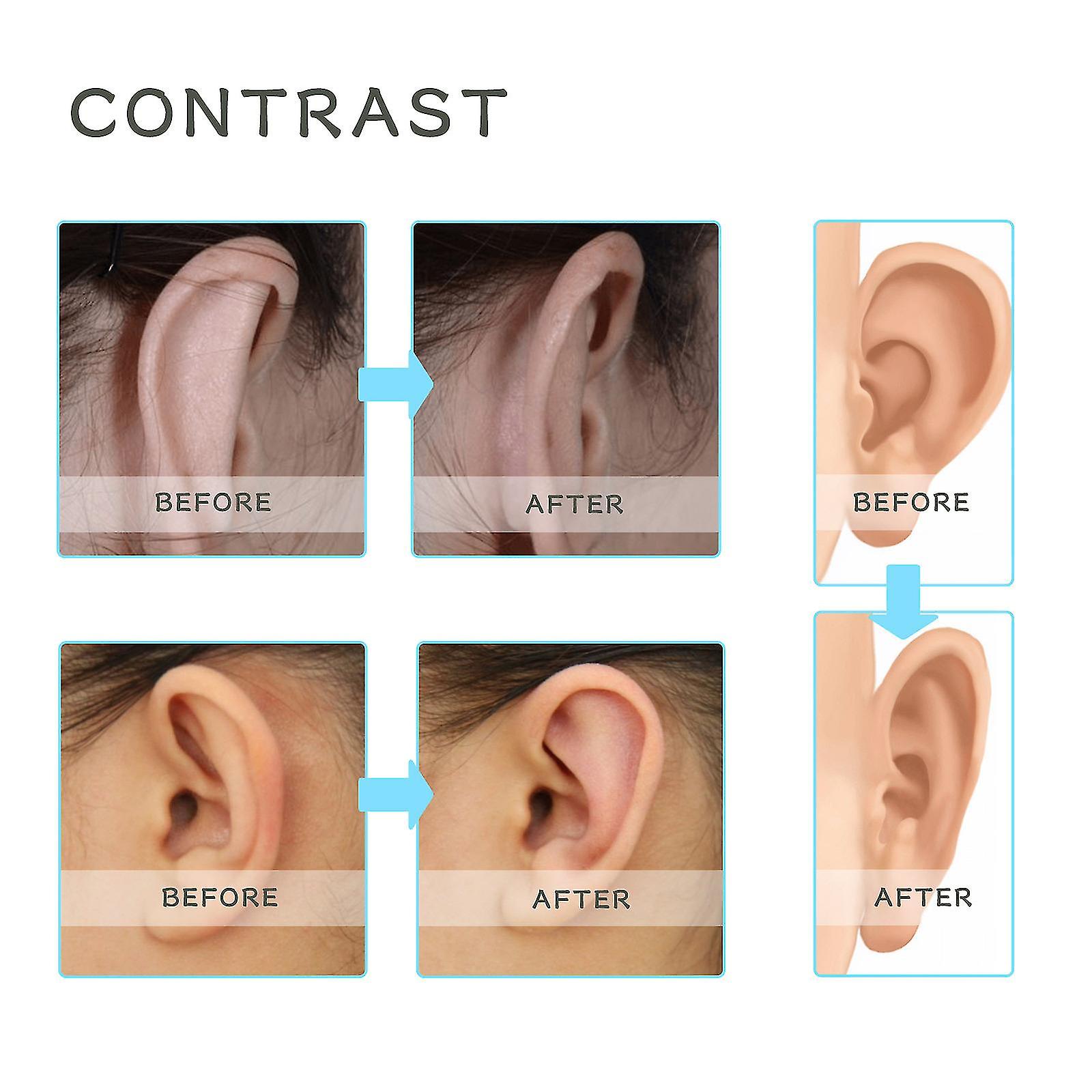 Silicone Ear Correctors Tape, Baby Auricle Valgus Correction Patch ...