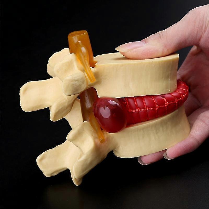 Medical props model free postage anatomical spine lumbar disc ...