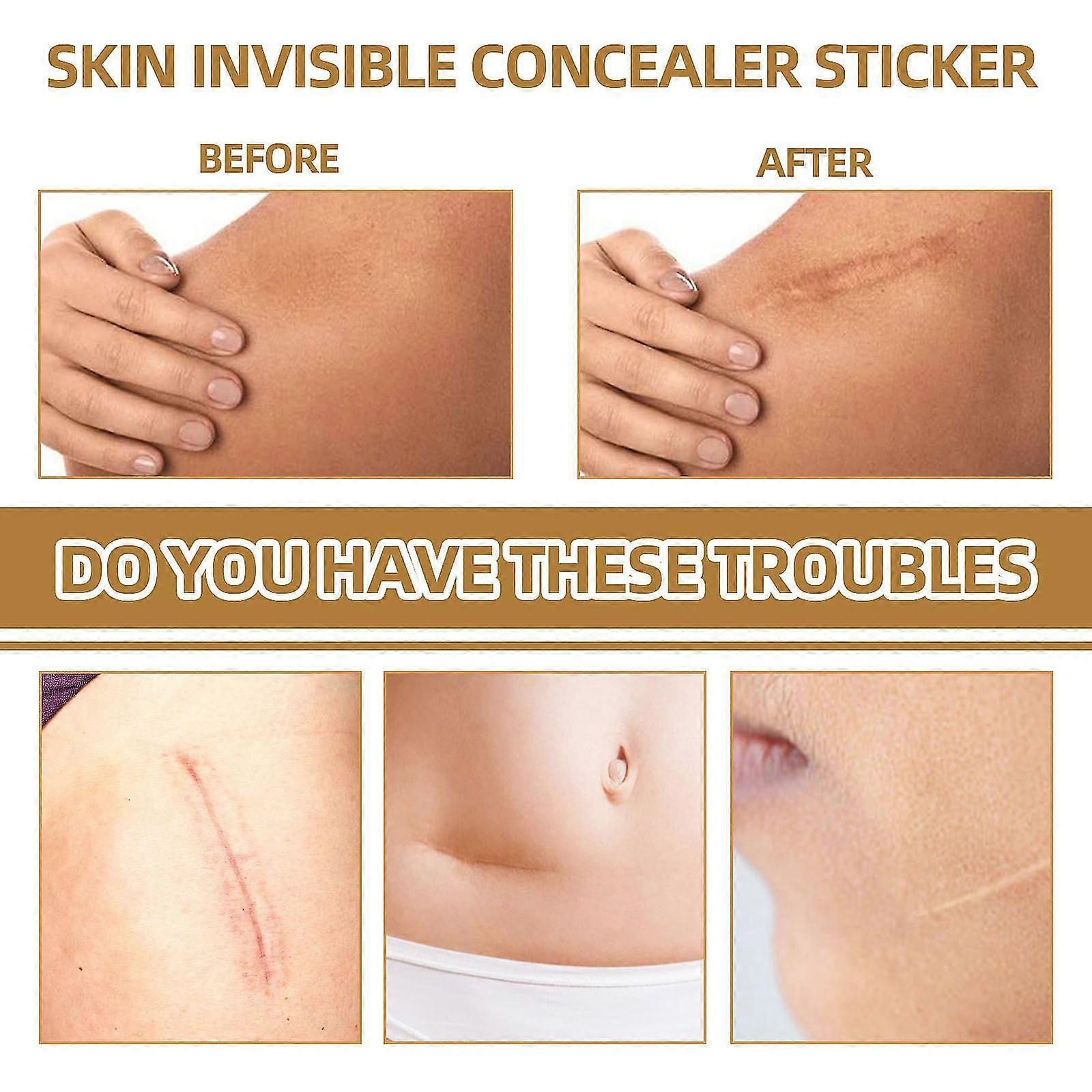 Skin Invisible Concealer Sticker Skin Color Invisible Sticker Sca ...