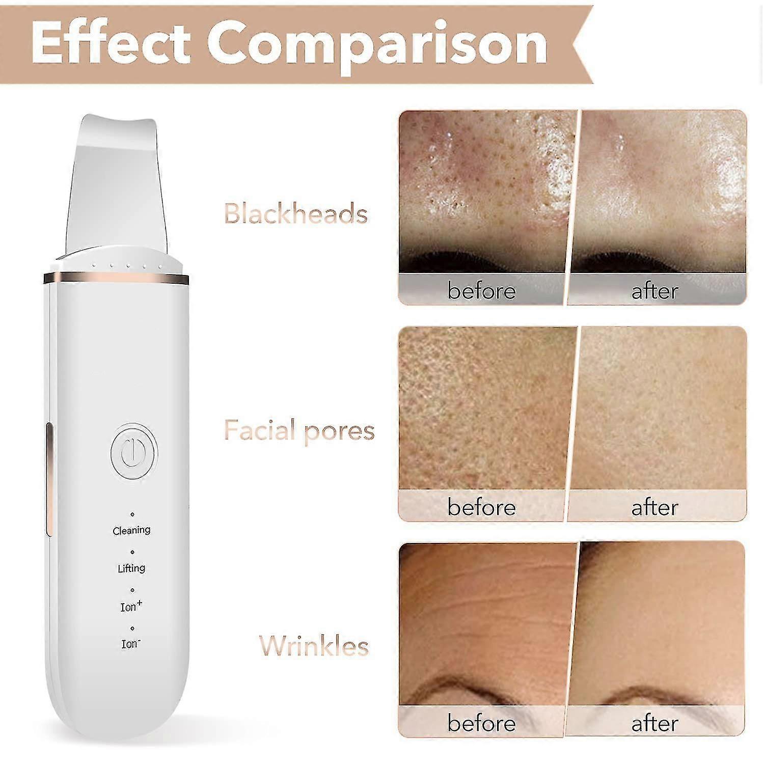 Skin Scrubber F Skin Spatula Blahead Remover Pore Cleaner F Beauty ...