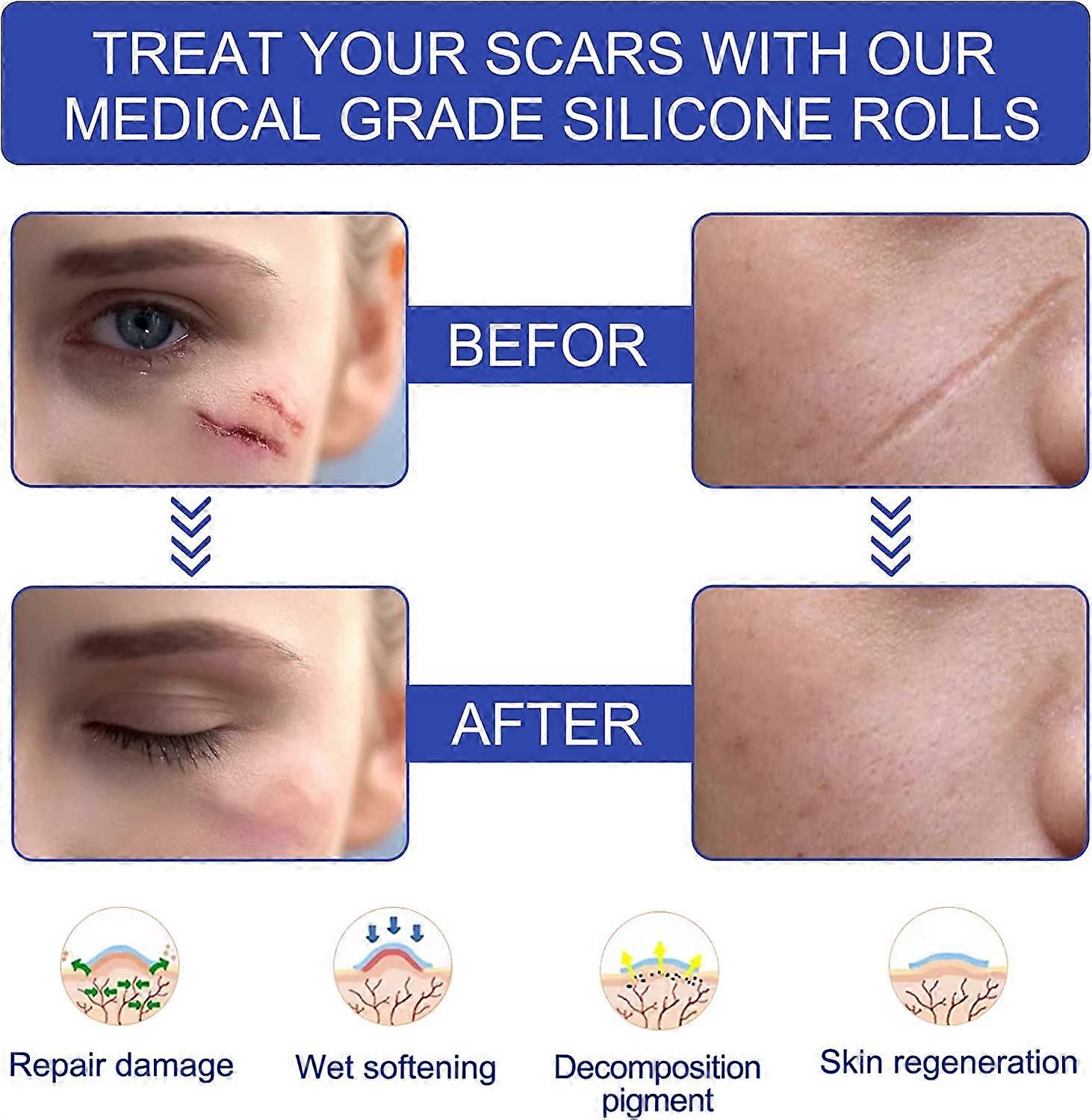 Silicone Scar Sheets, Medical Grade Soft Transparent Silicone Scar Tape ...