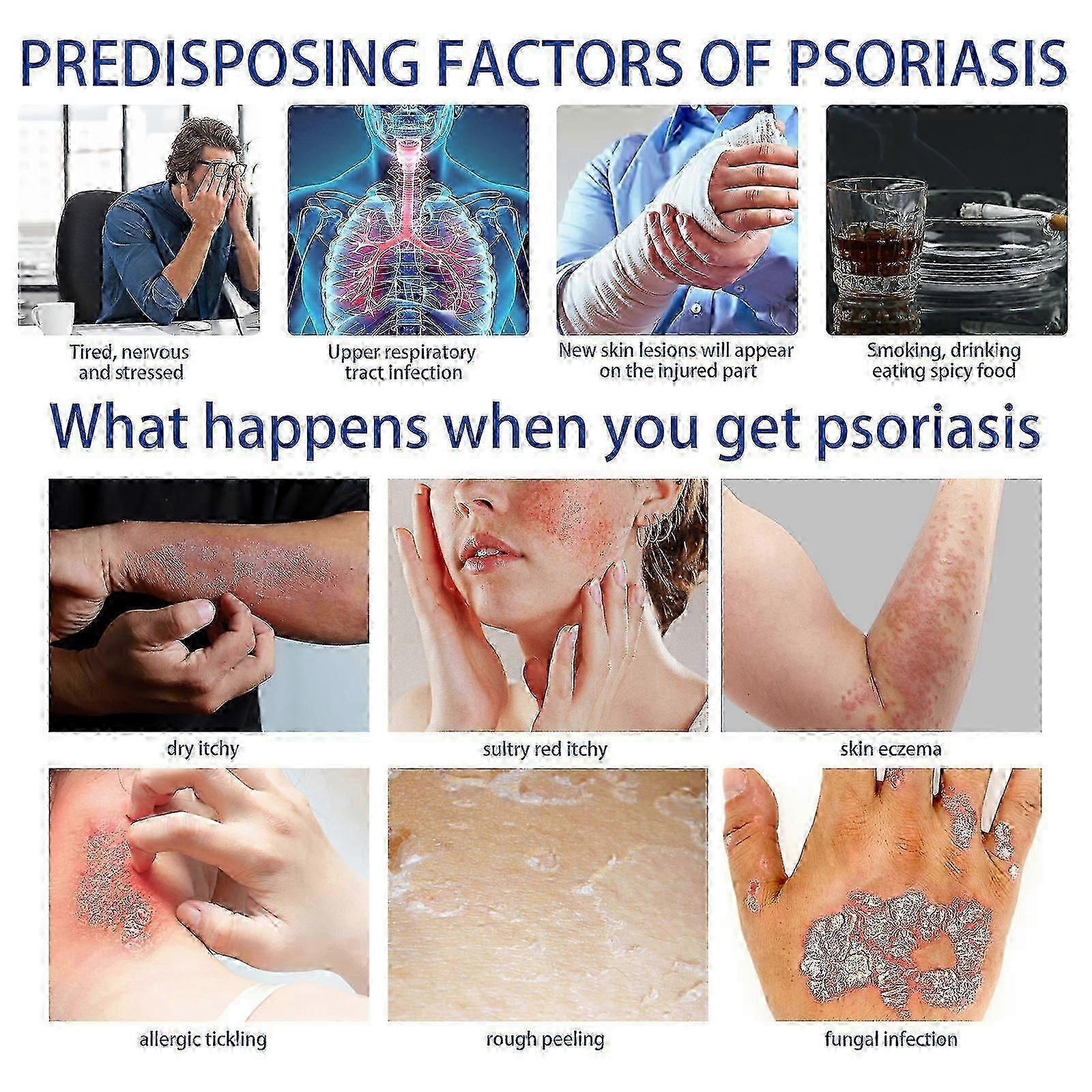 South Moon Anti-itch Cream for Dry and Itchy Skin, Rash, and Prickly ...