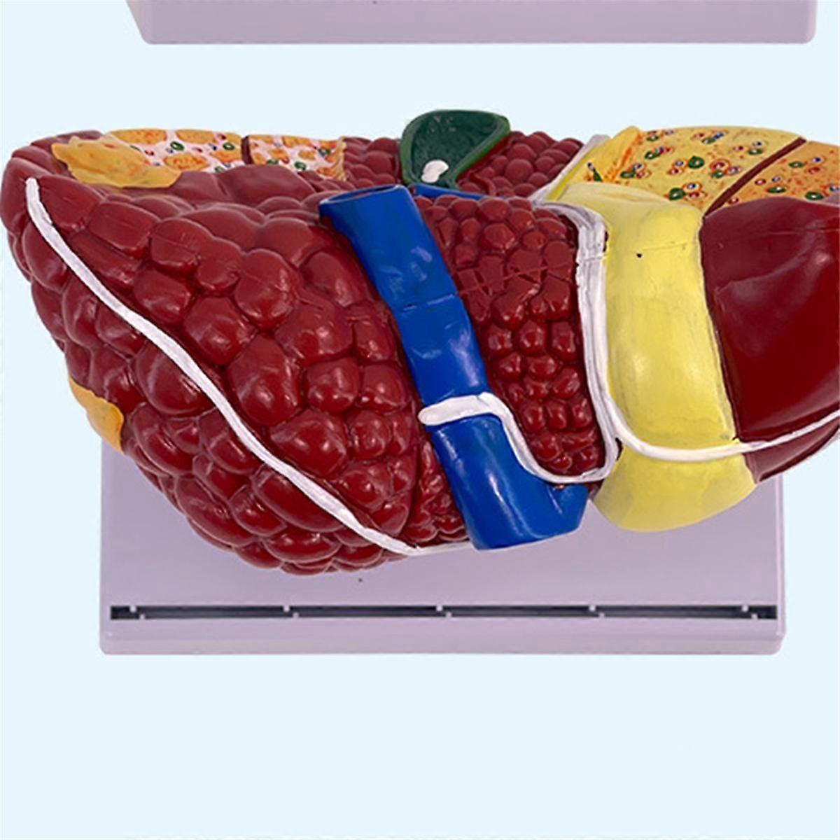 Liver Model for Common Pathologies, Liver Model Human Anatomy Doctor ...