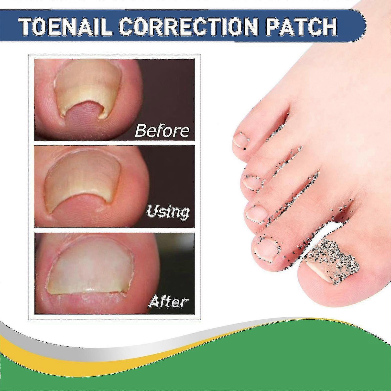 50 Sticks Toenail Groove Correction Stickers Nail Repair Toe Ingrown ...