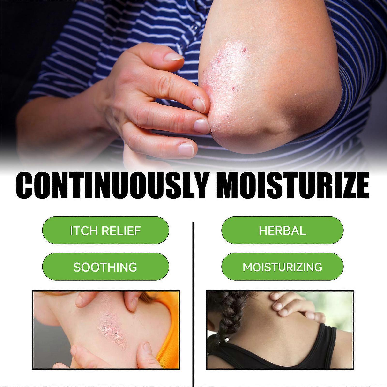 Skin care cream, psoriasis care cream, relieve the body skin itching ...