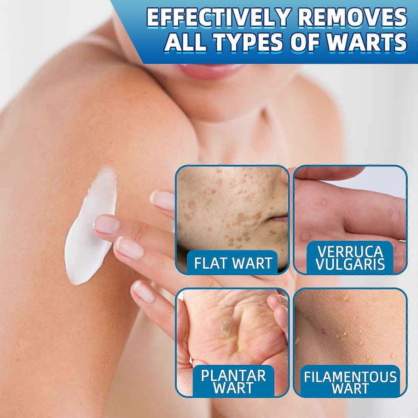 Wart Cream Skin Cleansing Wart Flattening Cream Facial Wart Filiform ...